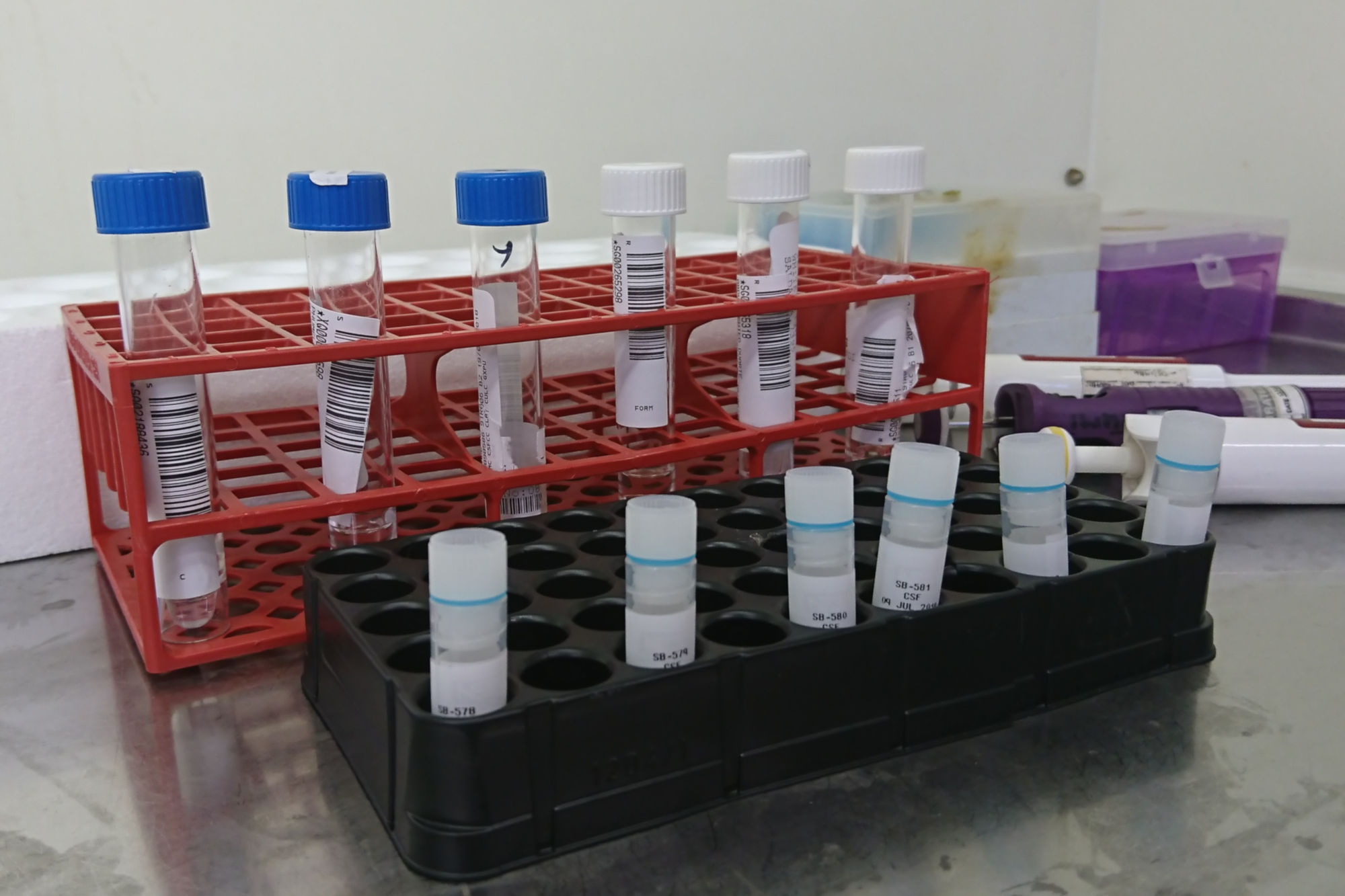 New TB meningitis test beats the rest | UCT News